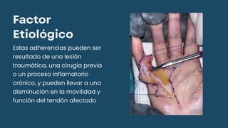 Tenolisis en lesiones de tendones del area de fisioterapia | PDF