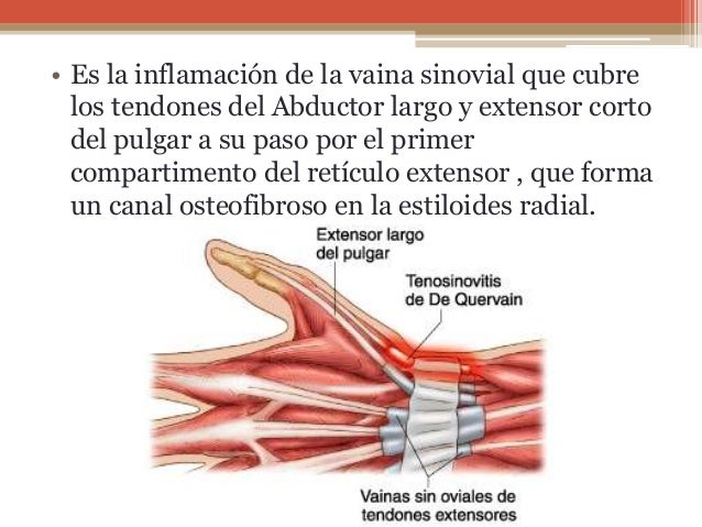 Tenosinovitis de quervain