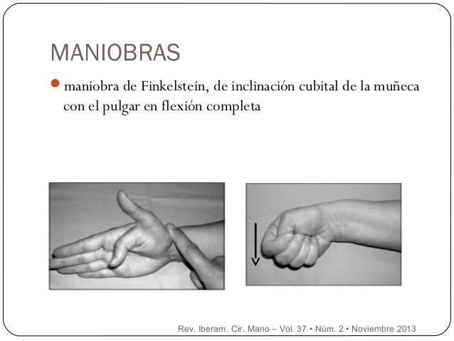 Tenosinovitis De Quervain