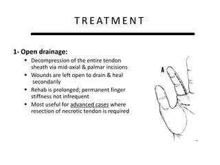 Flexor Tenosynovitis | PPTX