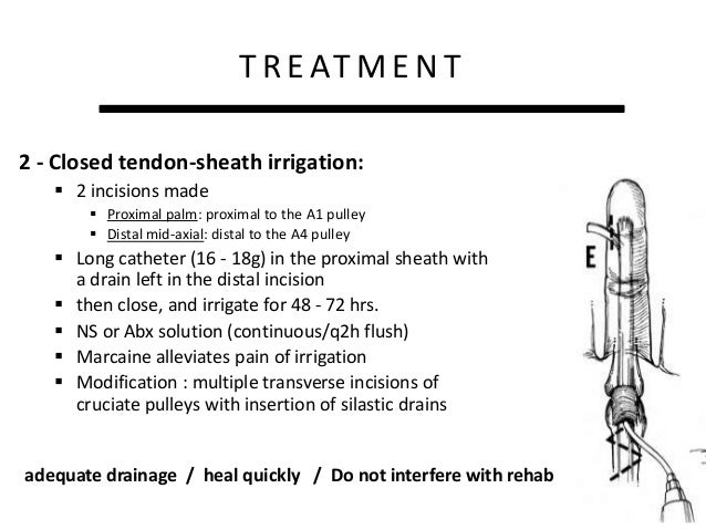 Flexor Tenosynovitis