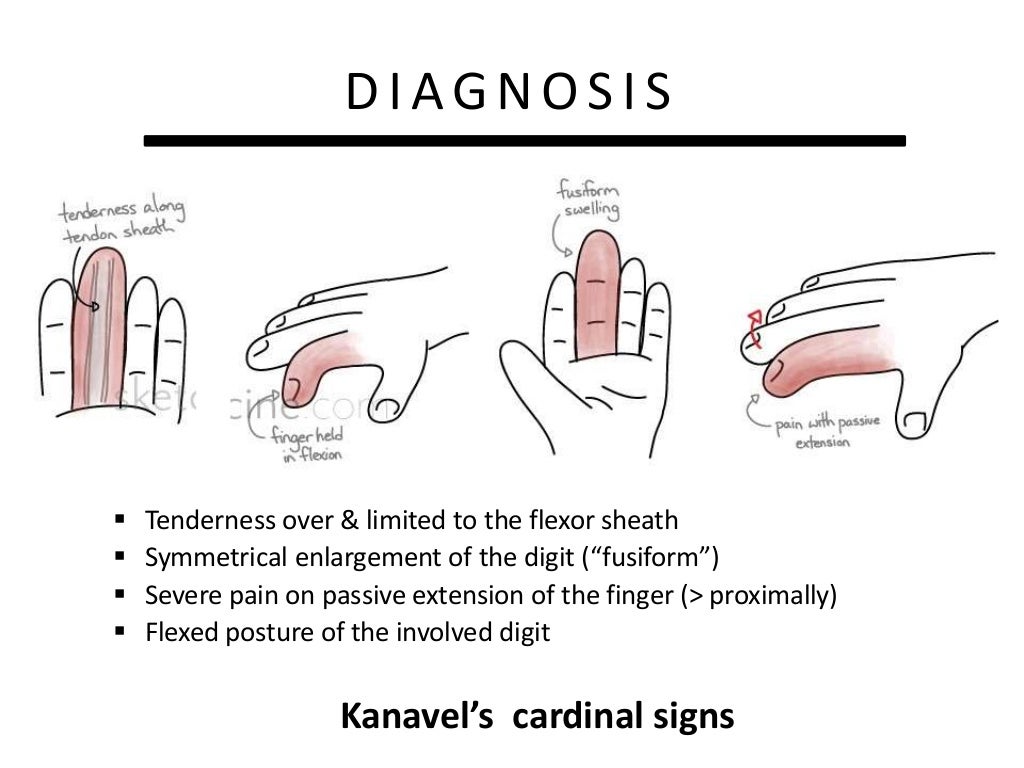 Flexor Tenosynovitis