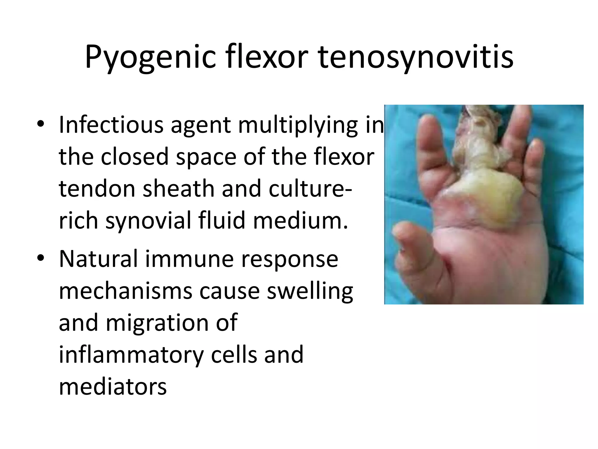 Tenosynovitis | PPTX