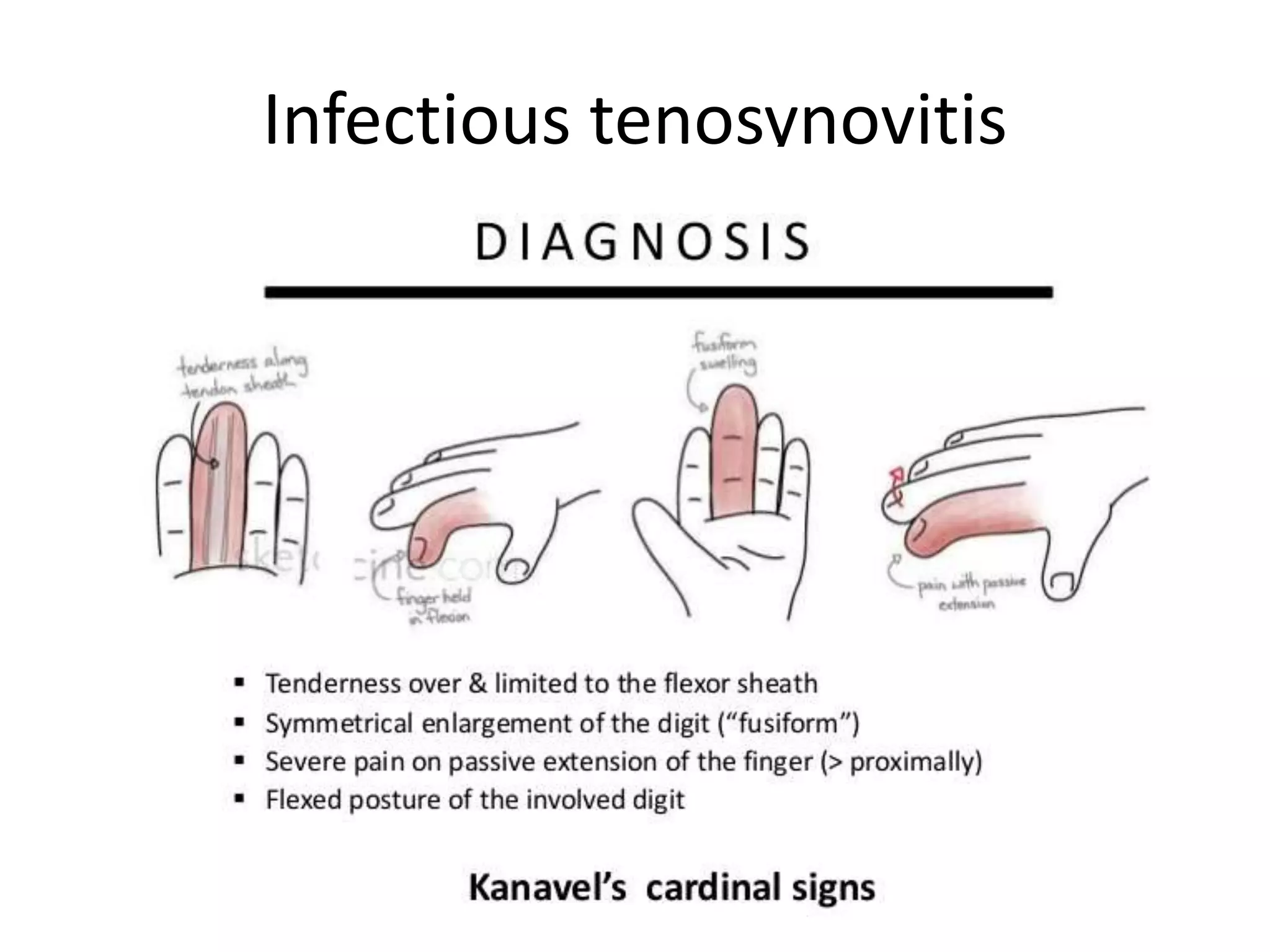 Tenosynovitis | PPTX