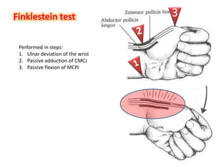 TENOSYNOVITIS.pptx