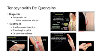 Tenosynovitis De Quervains.pptx