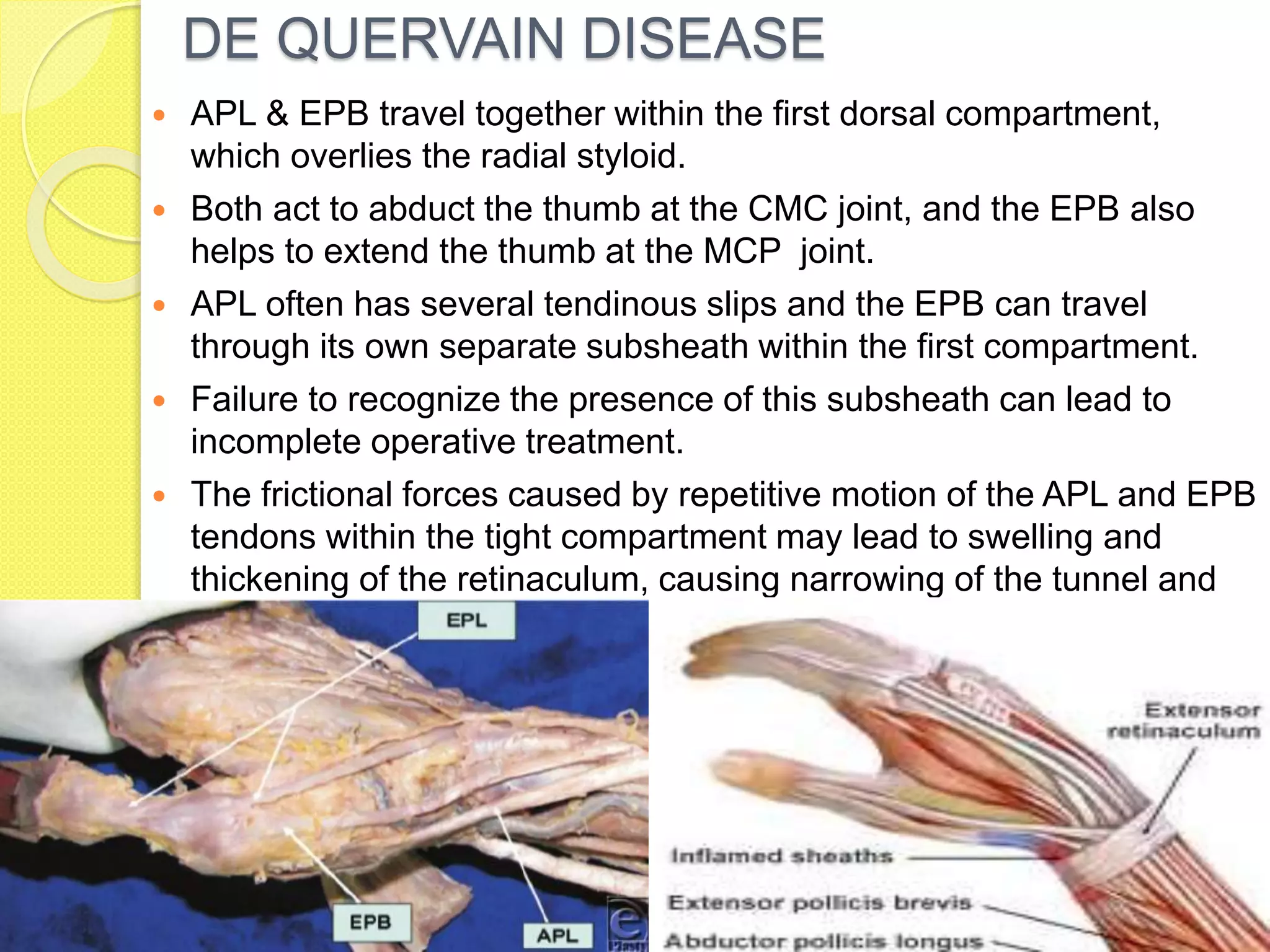 TENOSYNOVITIS DISORDERS OF UPPER EXTREMITY BY MAHEEN.pptx