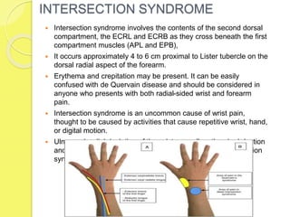 TENOSYNOVITIS DISORDERS OF UPPER EXTREMITY BY MAHEEN.pptx
