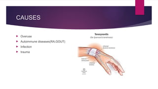 TENOSYNOVITIS EXPLAINED IN DETAILED MANNER | PPTX