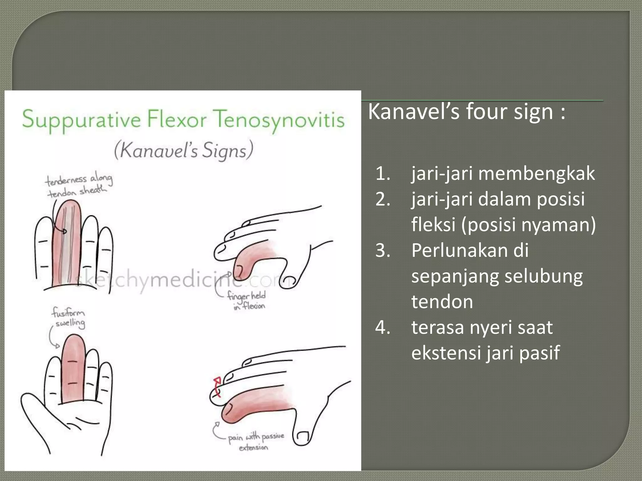 Tenosynovitis supuratif | PPTX