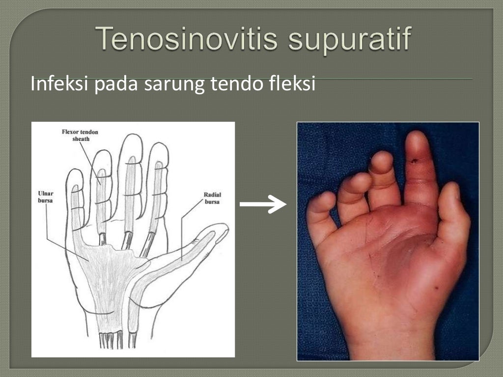 Tenosynovitis supuratif