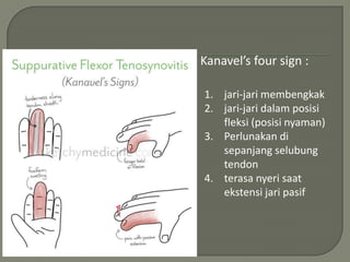 tenosynovitissupurative-130926055017-phpapp01 (1).pdf