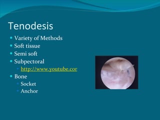 Tenotomy v tenodesis | PPT