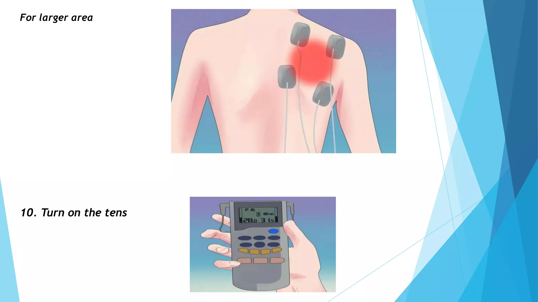 Tens transcutaneous electrical nerve stimulator | PPTX