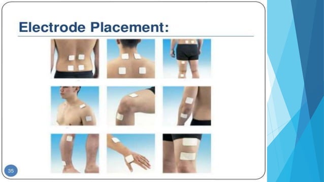 Tens transcutaneous electrical nerve stimulator | PPTX