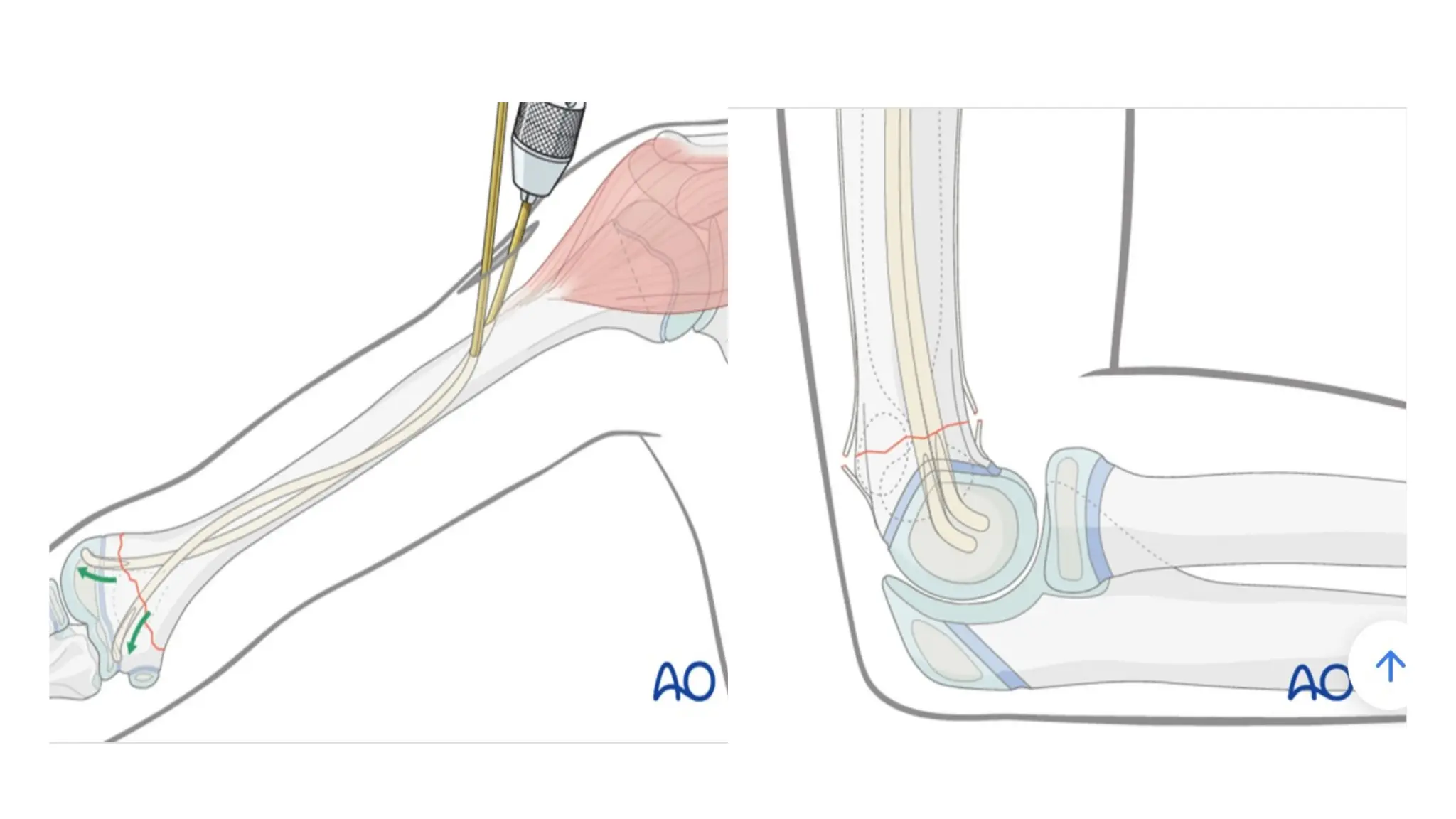 Titanium elastic nail system -all about.pptx