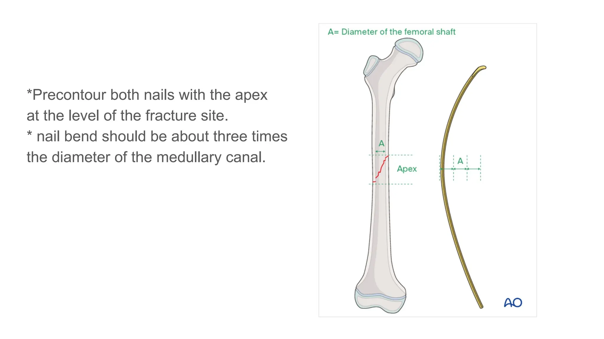 Titanium elastic nail system -all about.pptx