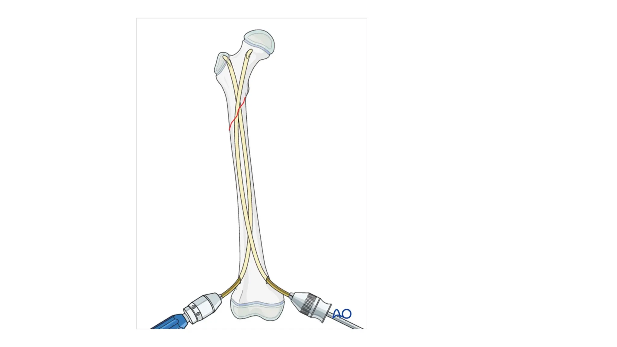 Titanium elastic nail system -all about.pptx