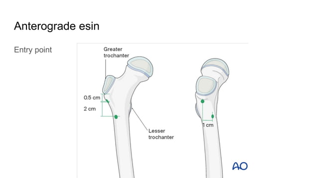 Titanium elastic nail system -all about.pptx