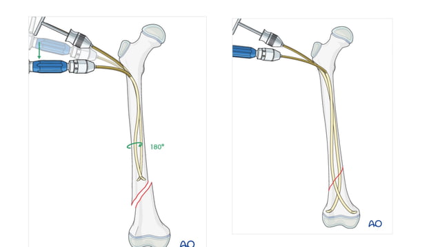 Titanium elastic nail system -all about.pptx