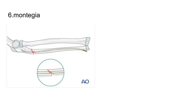Titanium elastic nail system -all about.pptx