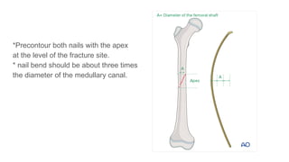 Titanium elastic nail system -all about.pptx