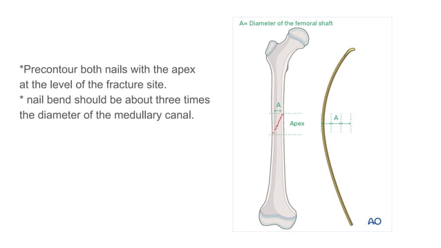 Titanium elastic nail system -all about.pptx