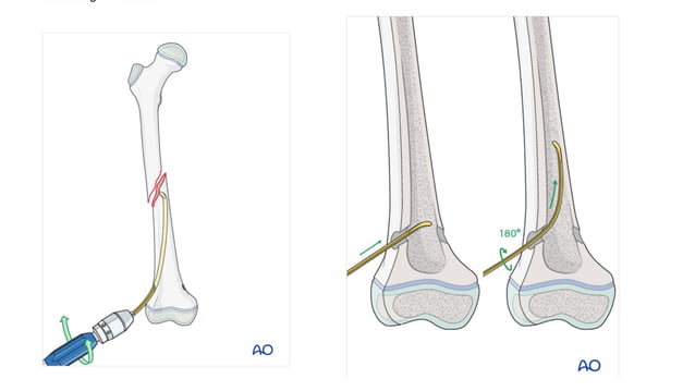 Titanium elastic nail system -all about.pptx