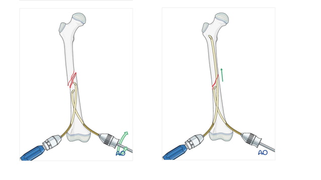 Titanium elastic nail system -all about.pptx