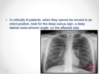 Tension Pneumothorax | PPTX