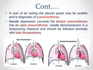Tension Pneumothorax Needle Decompression