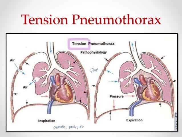 Tension pneumothorax - Pictures