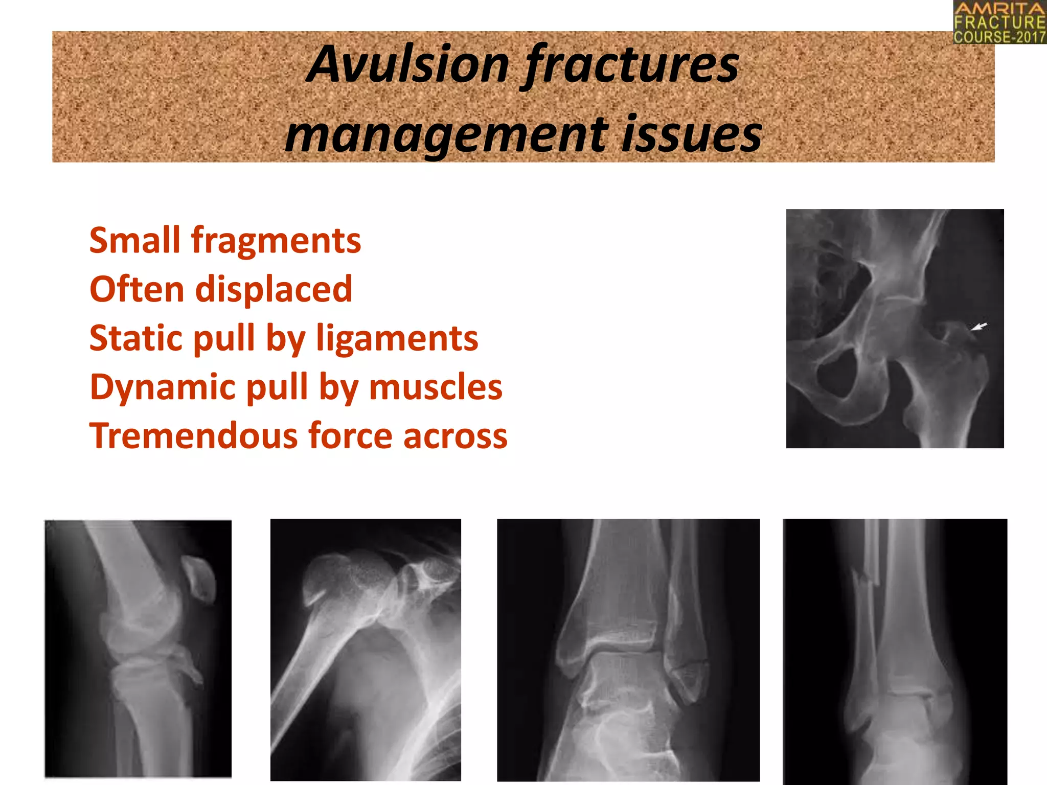 Tension band wiring and plating of fractures- dr mohamed ashraf.govt TD ...