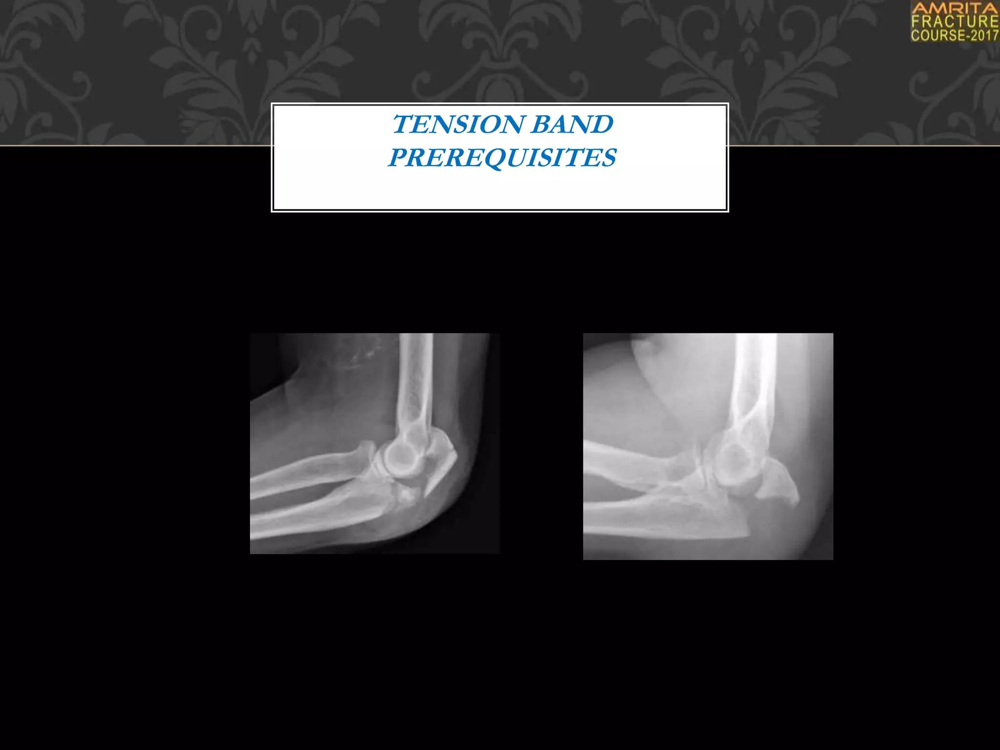 Tension band wiring and plating of fractures- dr mohamed ashraf.govt TD ...