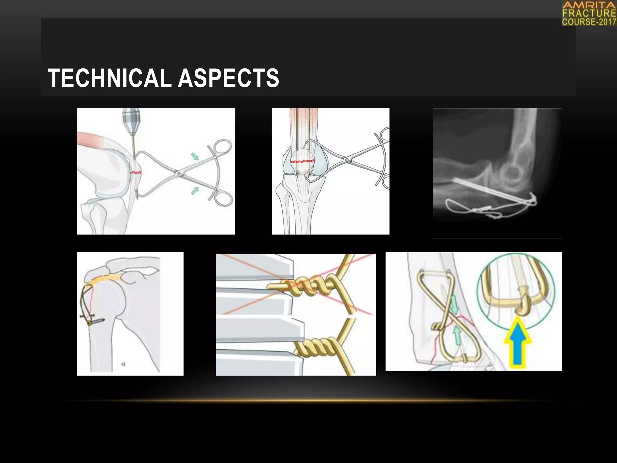 Tension band wiring and plating of fractures- dr mohamed ashraf.govt TD ...