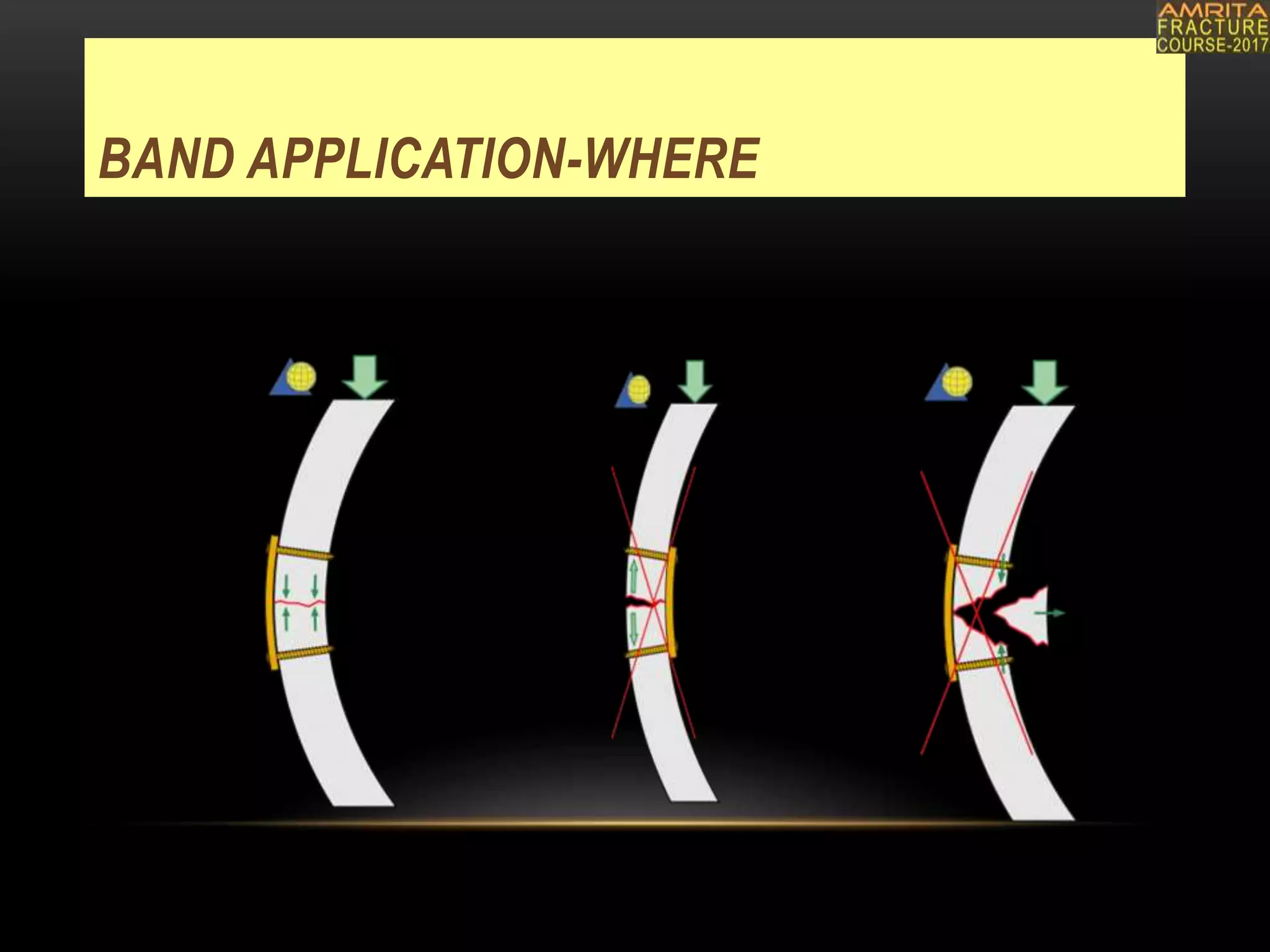 Tension band wiring and plating of fractures- dr mohamed ashraf.govt TD ...