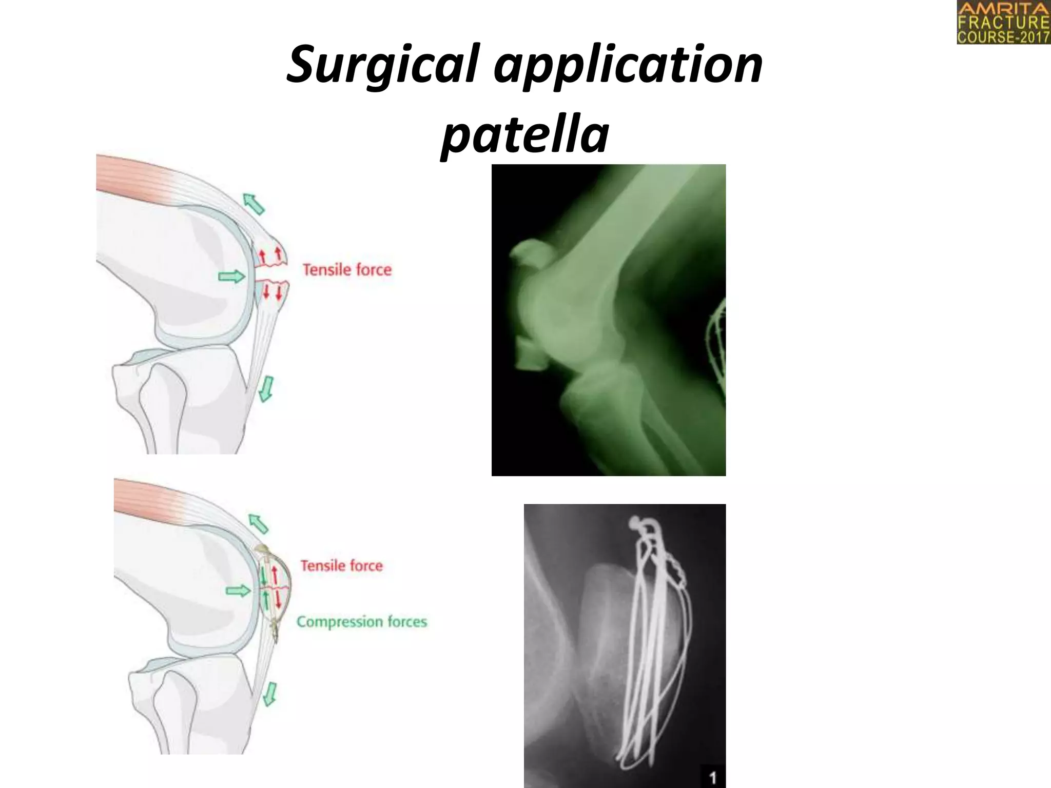 Tension band wiring and plating of fractures- dr mohamed ashraf.govt TD ...