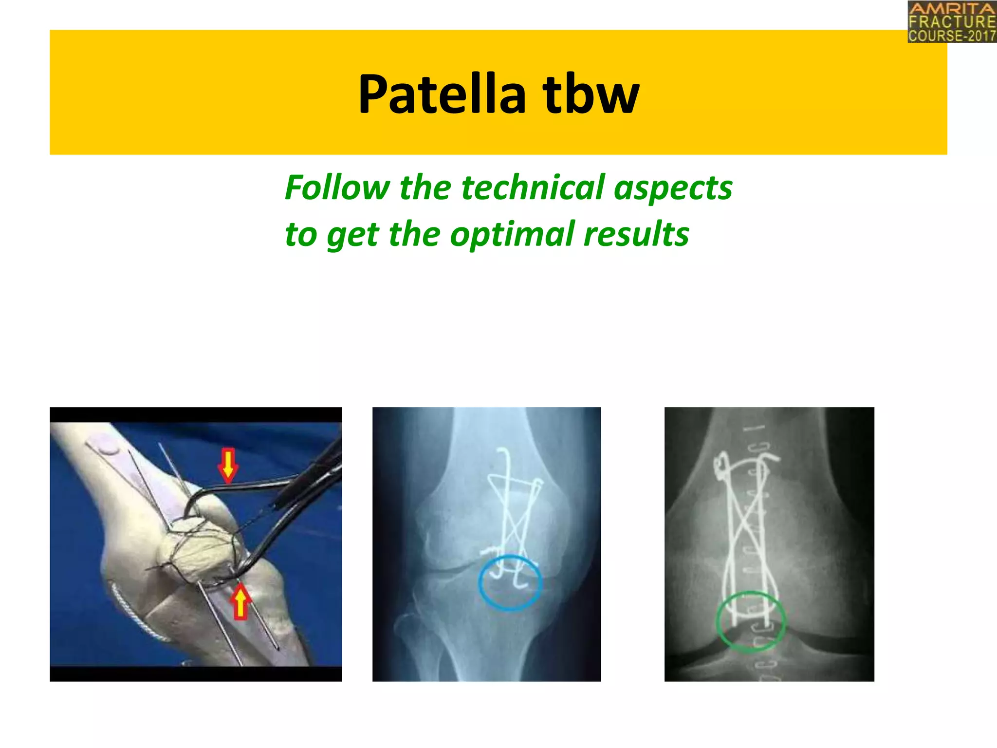 Tension band wiring and plating of fractures- dr mohamed ashraf.govt TD medical college,alleppey ...