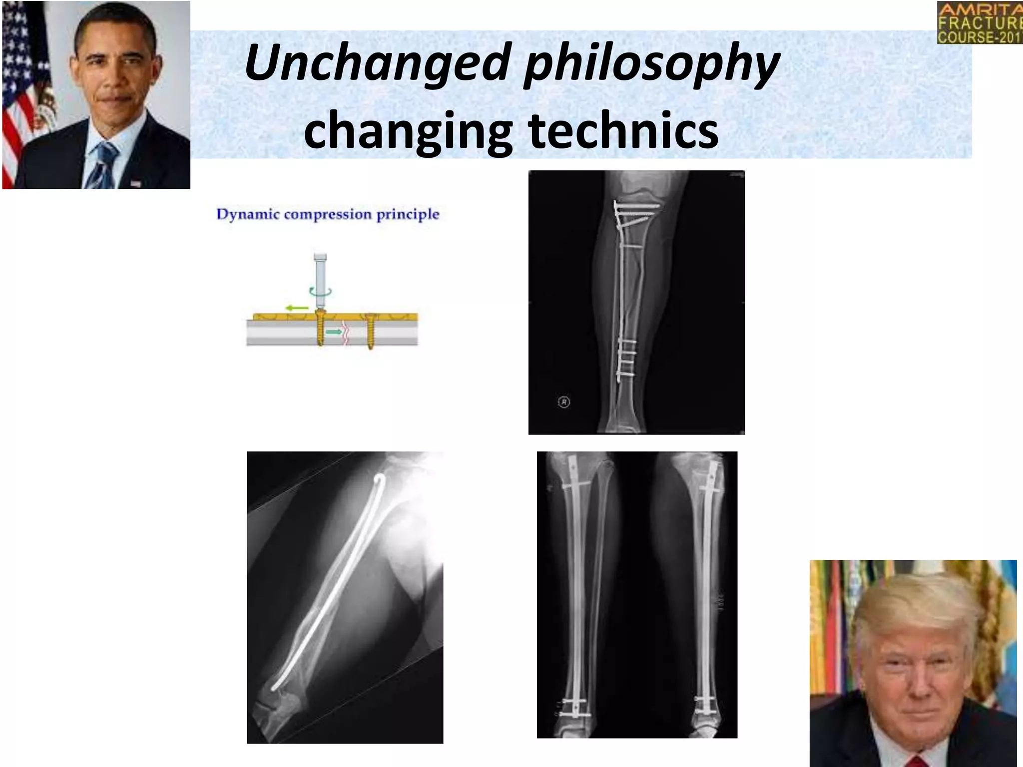 Tension band wiring and plating of fractures- dr mohamed ashraf.govt TD ...