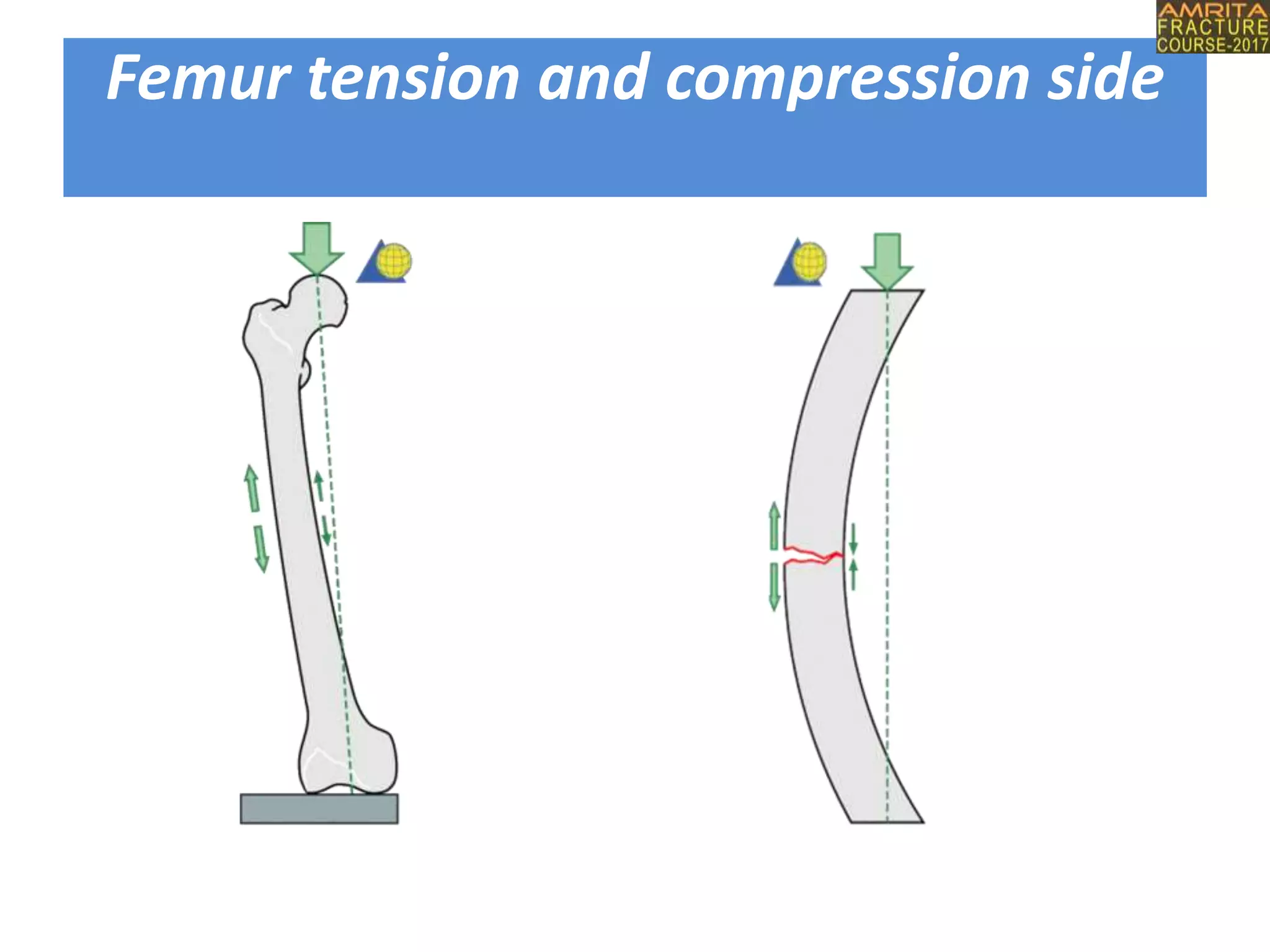 Tension band wiring and plating of fractures- dr mohamed ashraf.govt TD ...