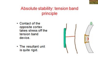 Tension band wiring and plating of fractures- dr mohamed ashraf.govt TD ...
