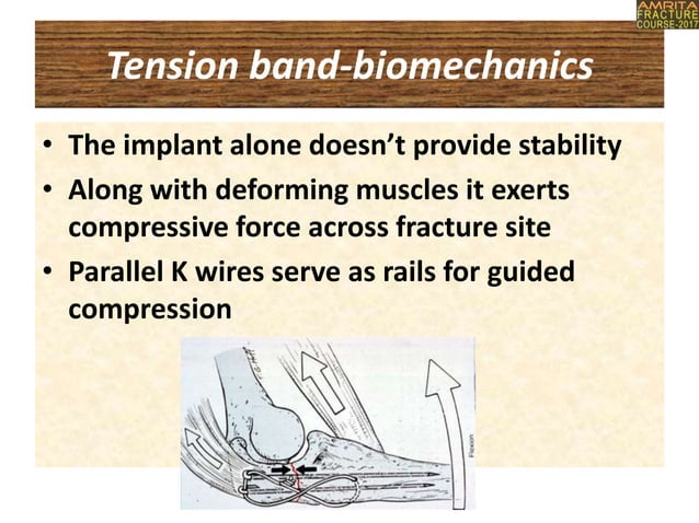 Tension band wiring and plating of fractures- dr mohamed ashraf.govt TD ...