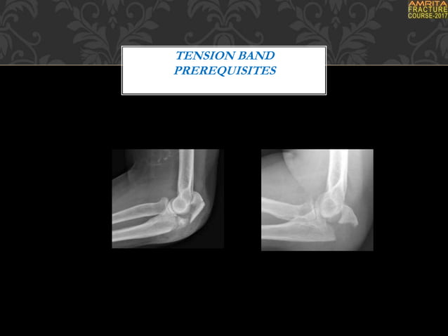 Tension band wiring and plating of fractures- dr mohamed ashraf.govt TD ...