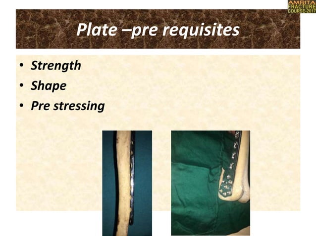 Tension band wiring and plating of fractures- dr mohamed ashraf.govt TD ...