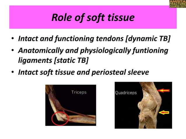 Tension band wiring and plating of fractures- dr mohamed ashraf.govt TD ...