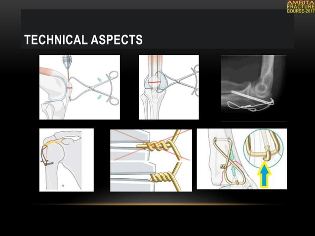 Tension band wiring and plating of fractures- dr mohamed ashraf.govt TD ...