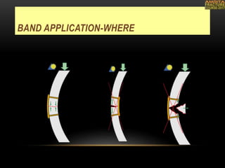 Tension band wiring and plating of fractures- dr mohamed ashraf.govt TD ...