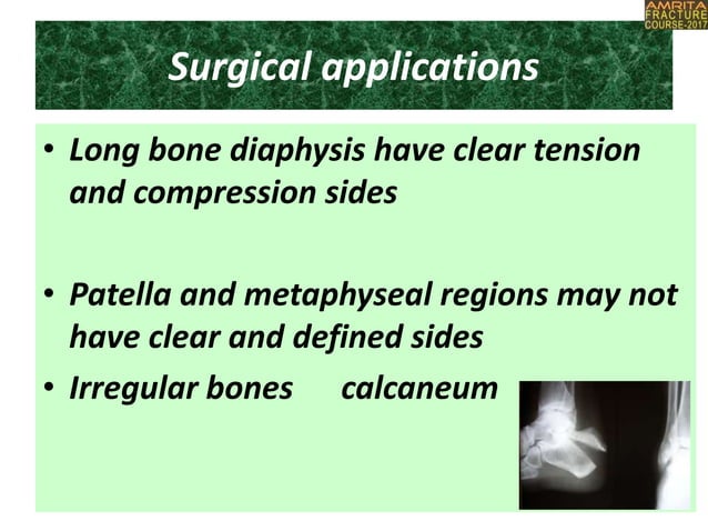 Tension band wiring and plating of fractures- dr mohamed ashraf.govt TD ...