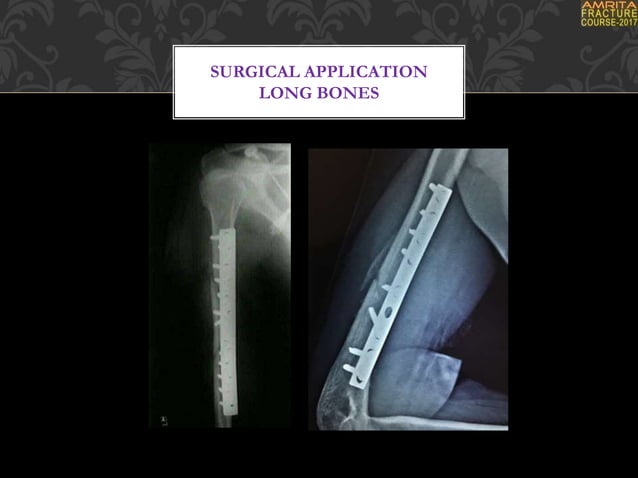 Tension band wiring and plating of fractures- dr mohamed ashraf.govt TD ...