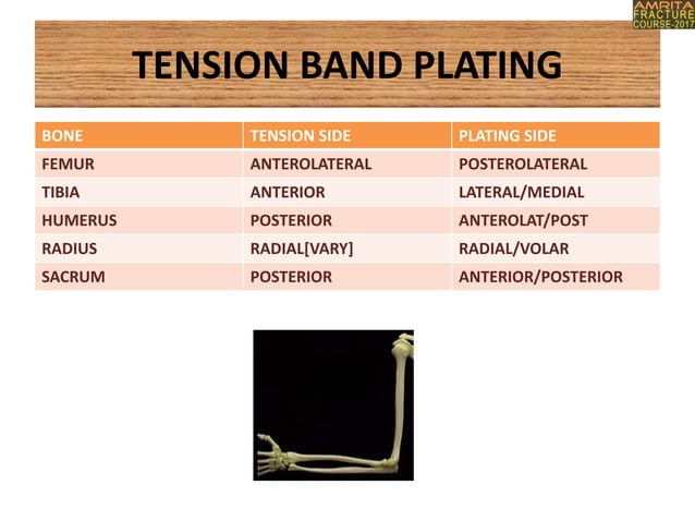 Tension band wiring and plating of fractures- dr mohamed ashraf.govt TD ...
